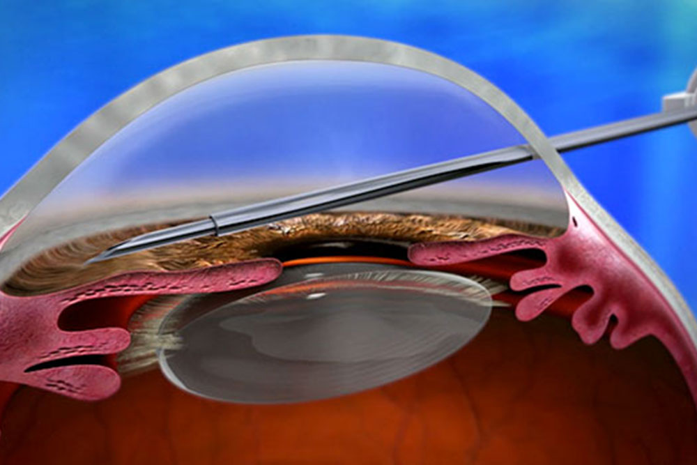 Xen Gel Stent